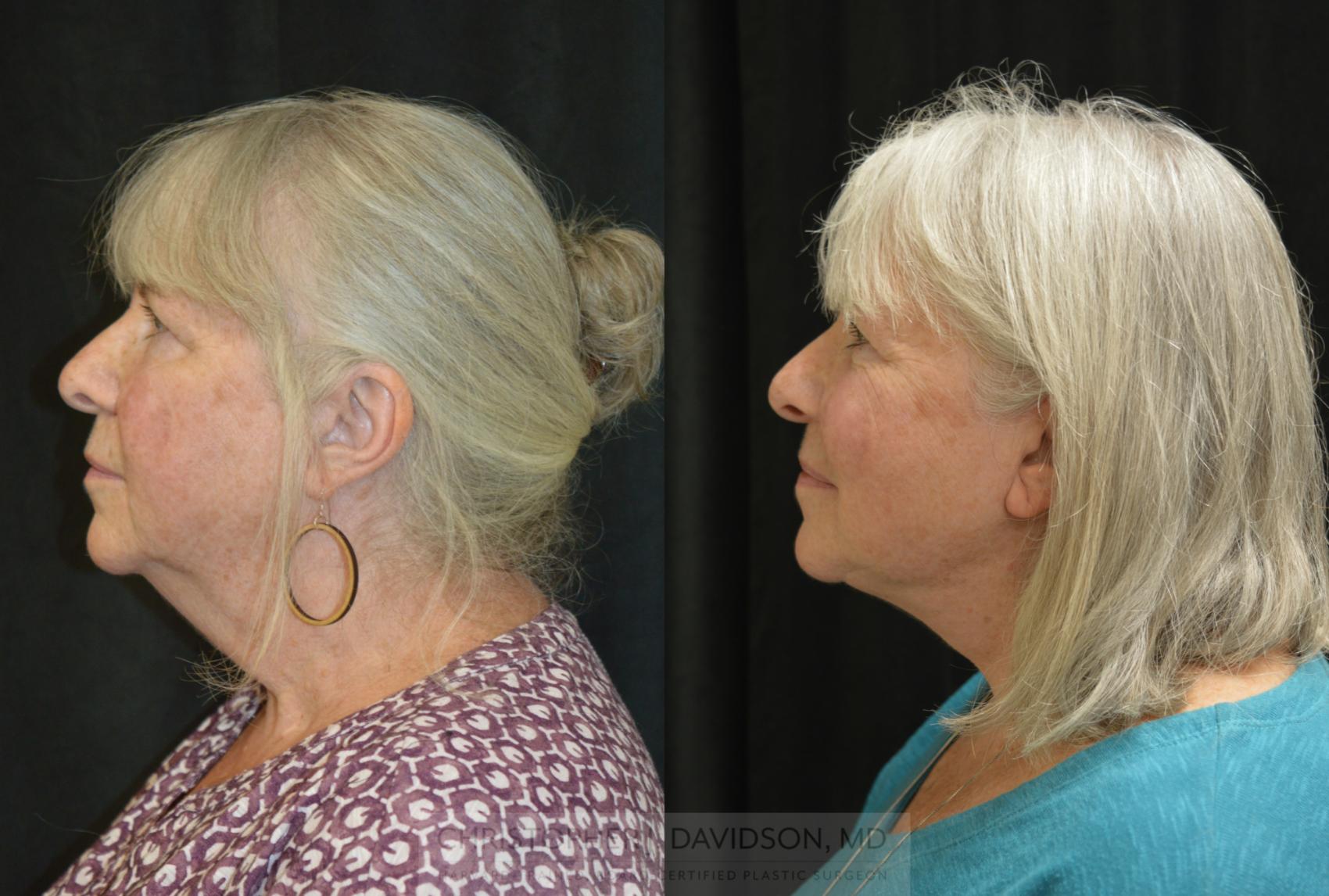 Neck Lift Before and After Pictures Case 288 | Boston, MA | Christopher ...