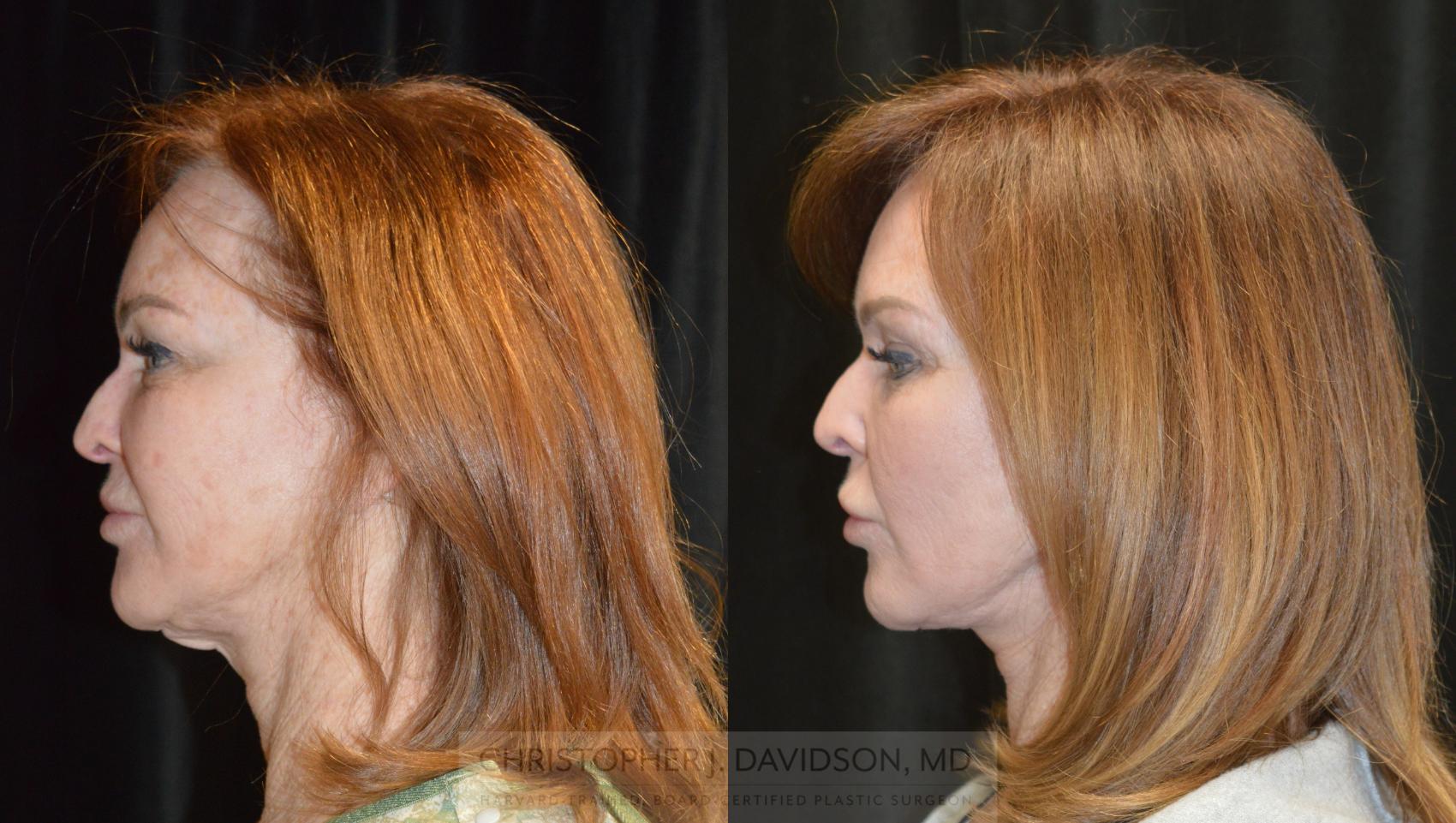 Neck Lift Before and After Pictures Case 314 | Boston, MA | Christopher ...