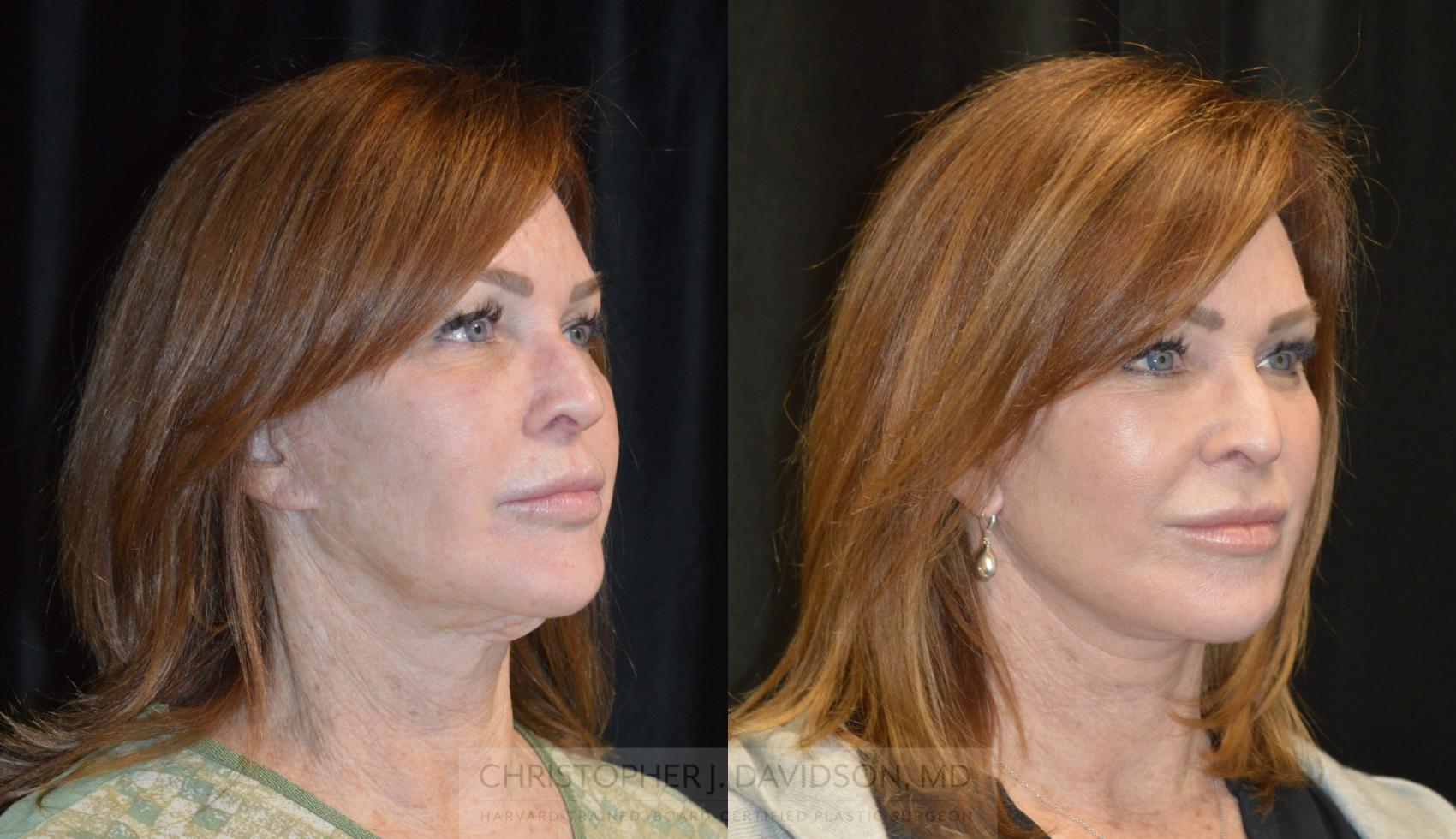 Neck Lift Before and After Pictures Case 314 | Boston, MA | Christopher ...