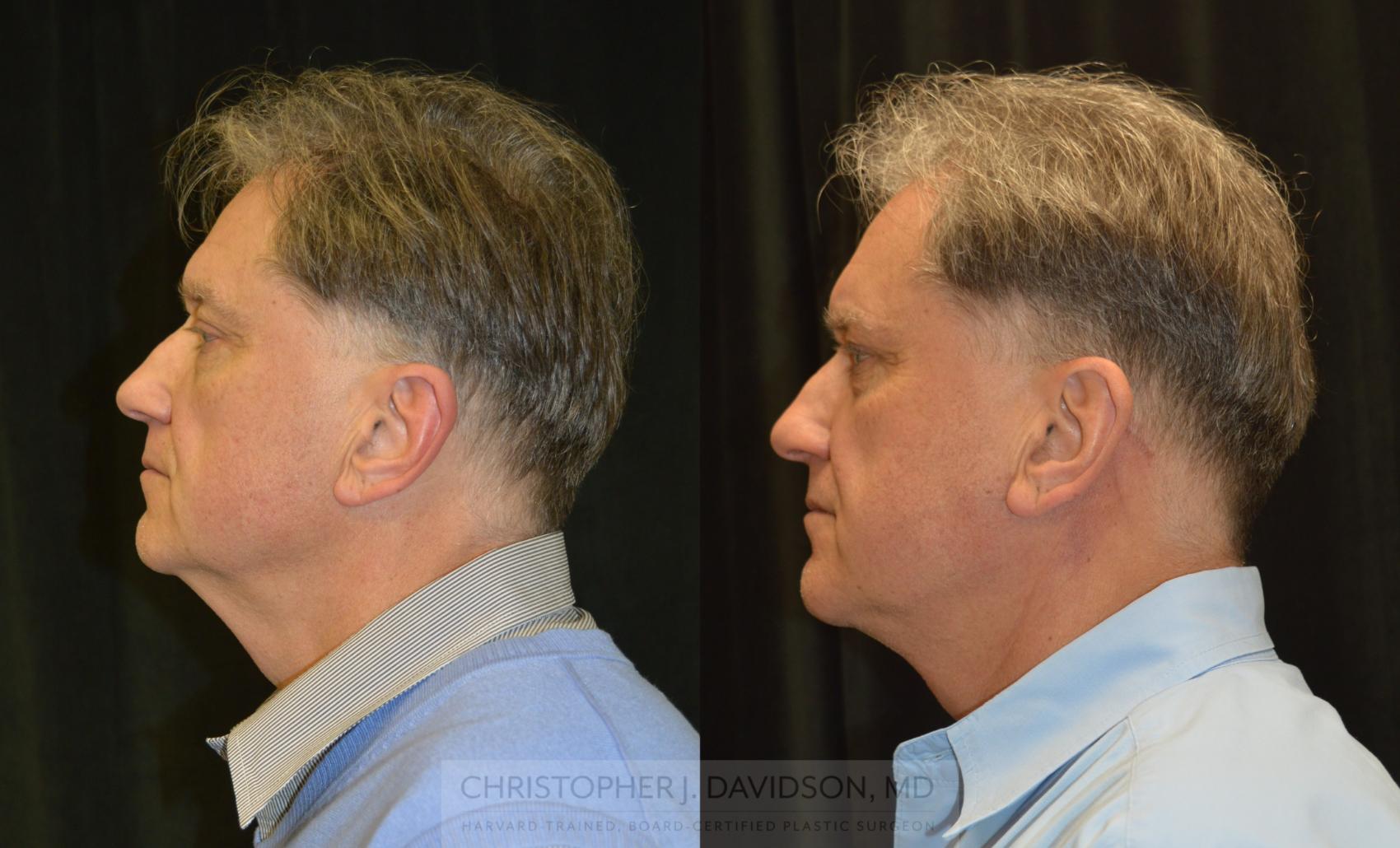 Neck Lift Before and After Pictures Case 322 | Boston, MA | Christopher ...